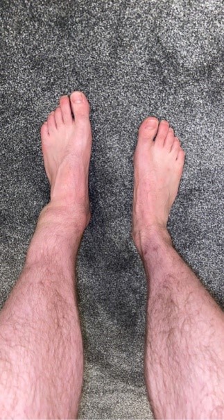 Andrews Ankle News | KH Physiotherapy | KH Physiotherapy